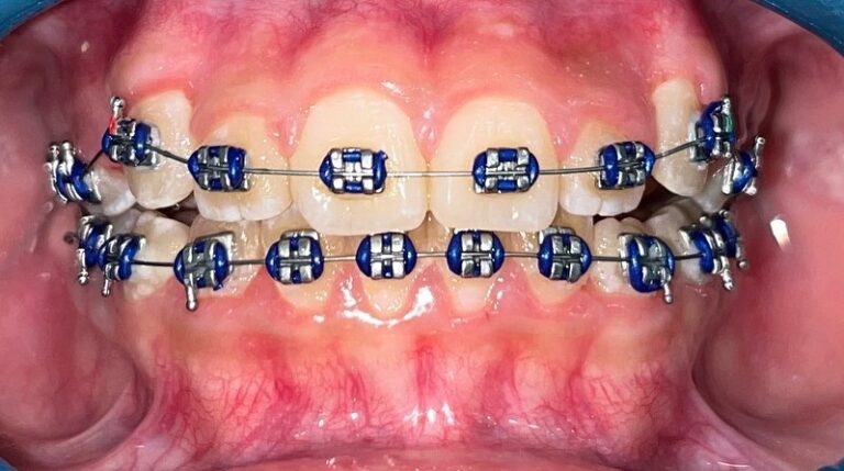Brackets estéticos y metálicos – Dra. Ingrid Alas